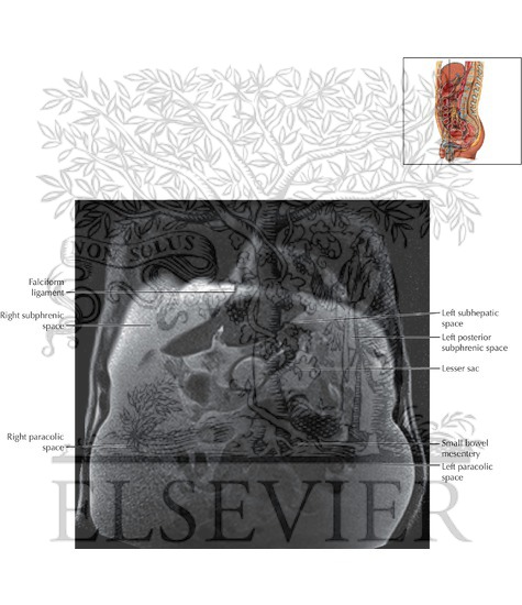 Peritoneal Cavity Abdomen Coronal 3
