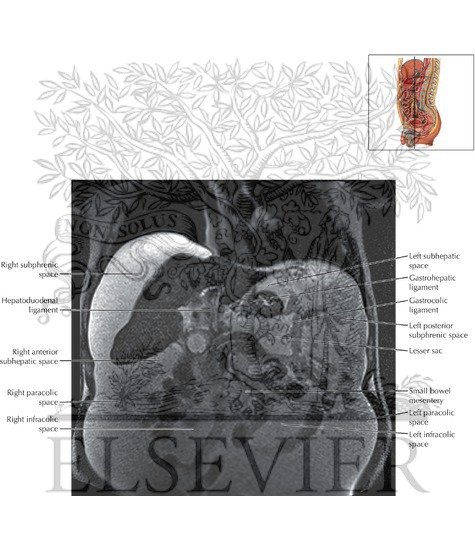 Peritoneal Cavity Abdomen Coronal 5