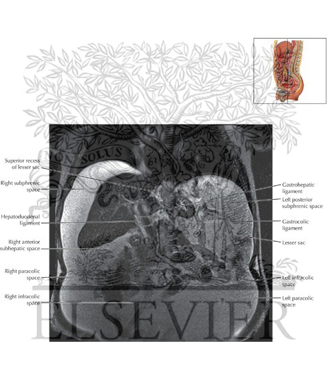 Peritoneal Cavity Abdomen Coronal 6