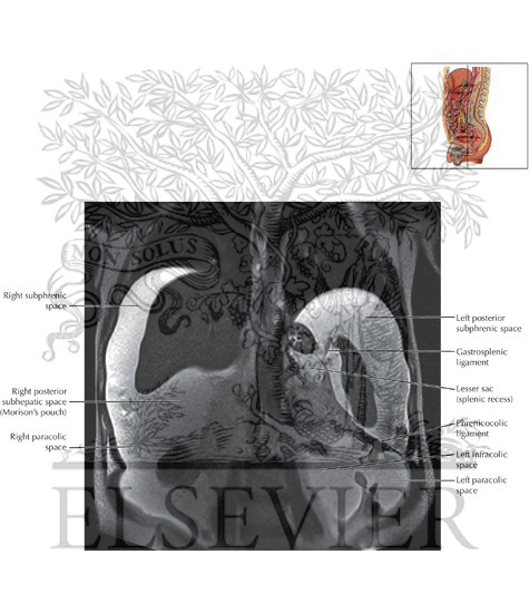 Peritoneal Cavity Abdomen Coronal 7
