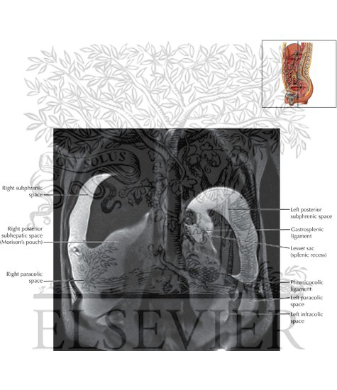 Peritoneal Cavity Abdomen Coronal 8