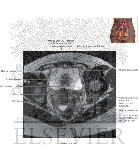 Peritoneal Cavity Pelvis Axial 7