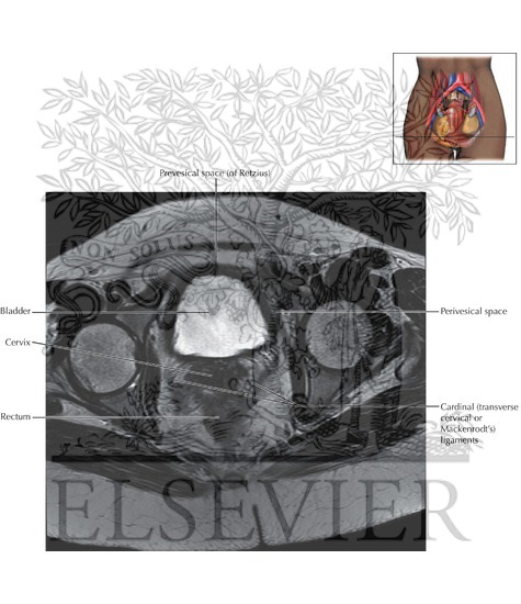 Peritoneal Cavity Pelvis Axial 8