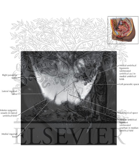 Peritoneal Cavity Pelvis Coronal 1