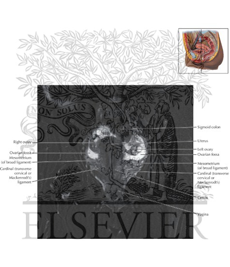 Peritoneal Cavity Pelvis Coronal 5