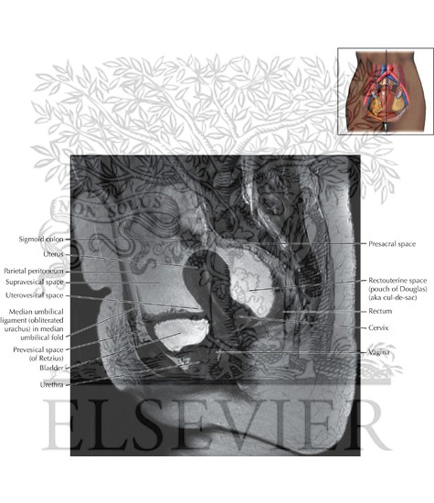 Peritoneal Cavity Pelvis Sagittal 4