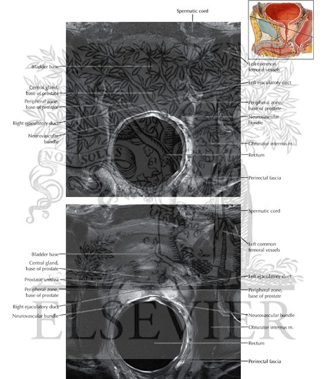 Prostate and Seminal Tract Axial 6