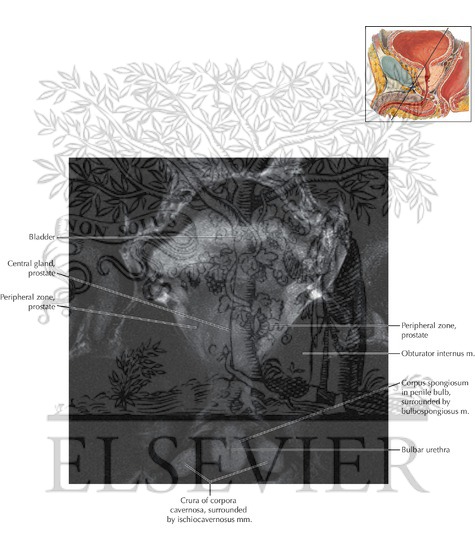 Prostate and Seminal Tract Coronal 1