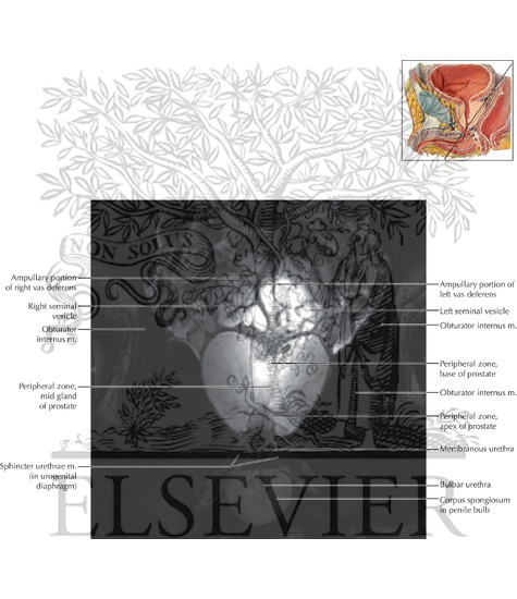 Prostate and Seminal Tract Coronal 4