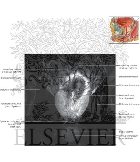 Prostate and Seminal Tract Coronal 5