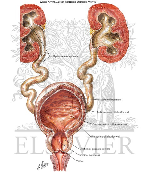 outflow obstruction bladder