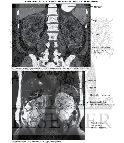 Polycystic Kidney Disease: Radiographic Findings
