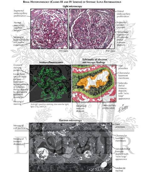 Lupus Nephritis: Renal Histopathology (Classes III and IV Lesions)
