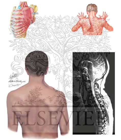 Long Thoracic and Spinal Accessory Nerves