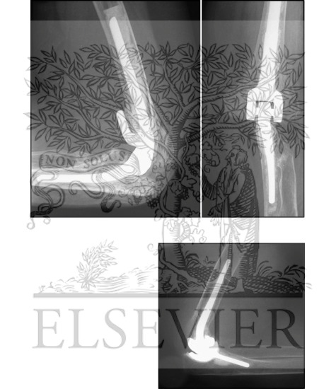 Arthritis: Imaging of Total Elbow Arthroplasty Designs