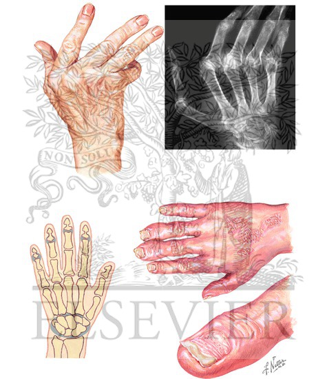 Hand Involvement in Rheumatoid Arthritis and Psoriatic Arthritis