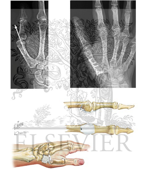Deformities of Thumb Joints: Carpometacarpal Osteoarthritis