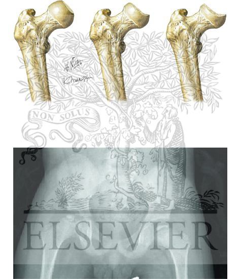 Legg-Calvï¿½-Perthes Disease: Lateral Pillar Classification