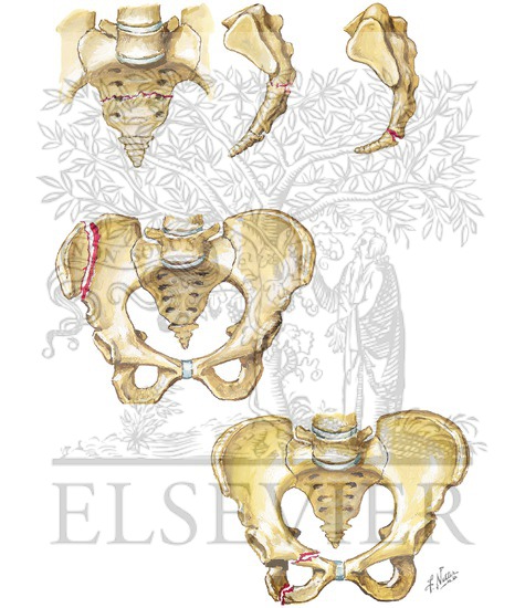 Injury to Pelvis: Stable Pelvic Ring Fractures