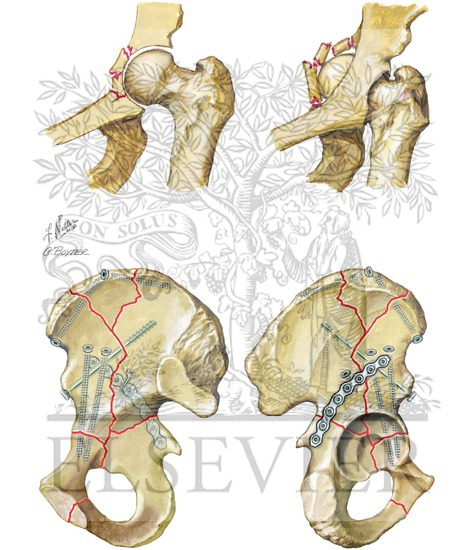 Injury to Hip: Acetabular Fractures (Continued)