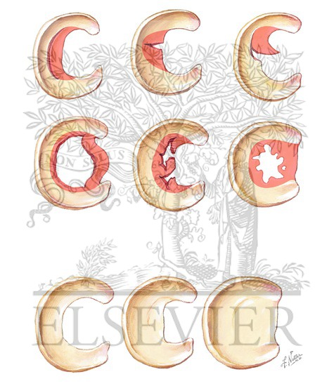 Types of Meniscal Tears and Discoid Meniscus Variations