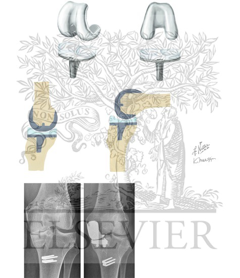 Knee Arthroplasty: Total Condylar Prosthesis and Unicompartmental ...
