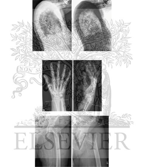 Radiology of Osteopenia (Continued)