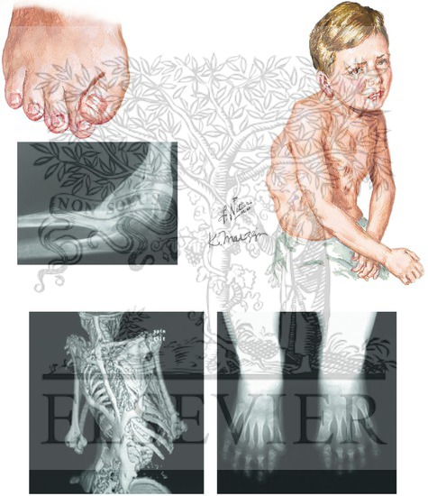 Fibrodysplasia Ossificans Progressiva