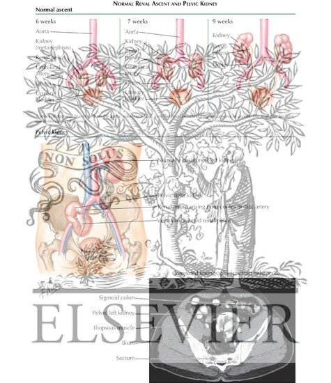 Renal Ascent and Ectopia: Normal Renal Ascent and Pelvic Kidney