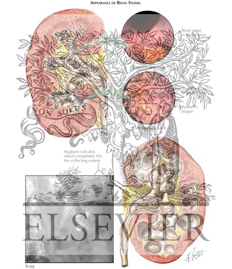 Urolithiasis: Appearance of Renal Stones