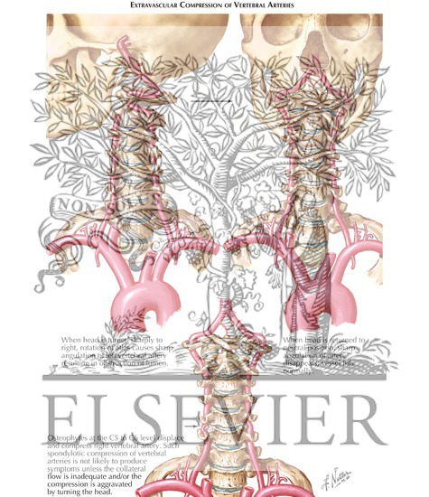 Compression of Vertebral Arteries