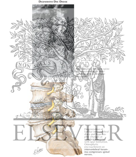 Degenerative Disc Disease