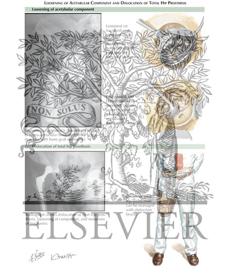 Loosening of Acetabular Component, Dislocation of Total Hip Prosthesis