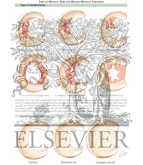 Types of Meniscal Tears and Discoid Meniscus Variations