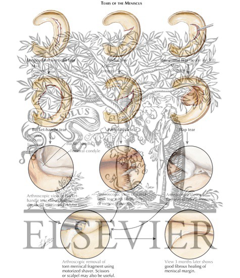 Tears of the Meniscus