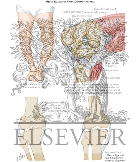 Medial Release for Varus Deformity of Knee