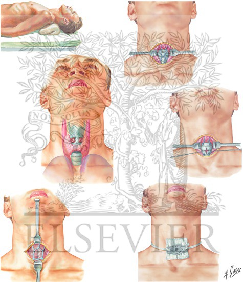 trach procedure steps