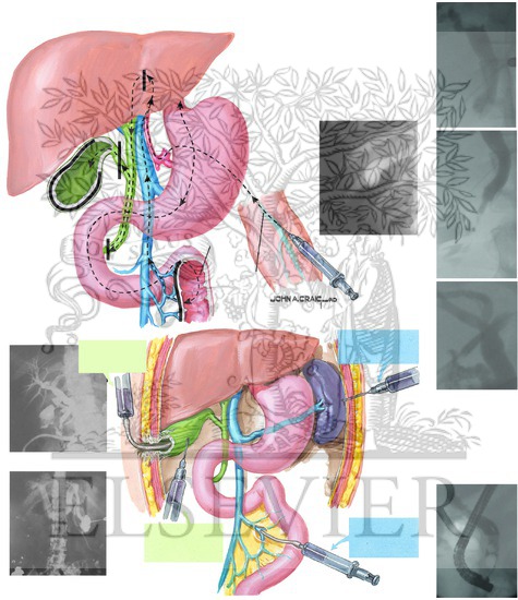 Intraoperative Imaging in Cholecystectomy
