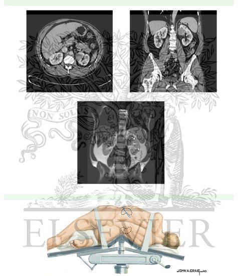 Preoperative Imaging of Renal Mass and Surgical Approach