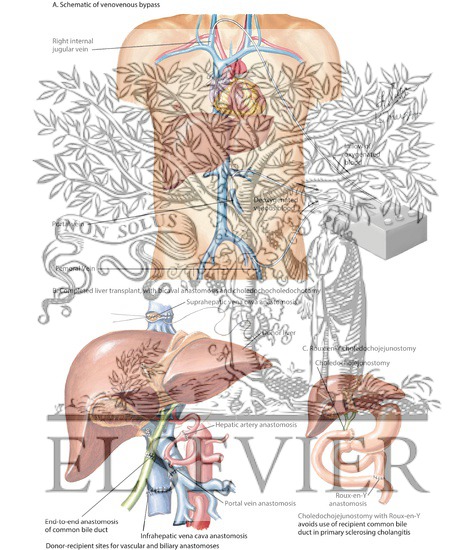 Liver Surgical Approaches and Completed Transplant