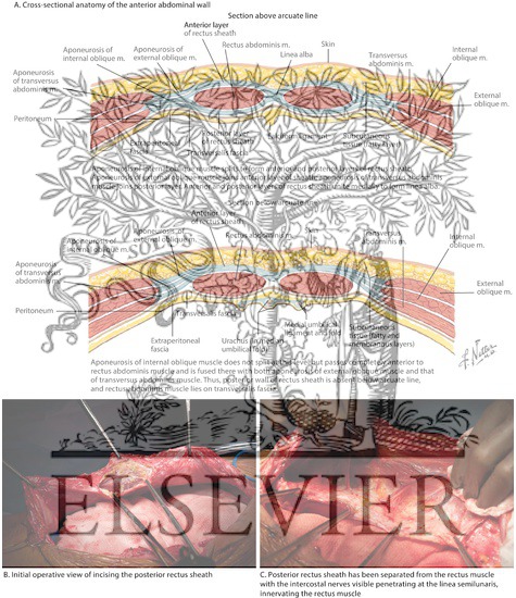 Cross Section of Anterior Abdominal Wall and Creation of Retrorectus Space