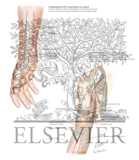 Radiocephalic, Brachiocephalic, and Brachiobasilic Arteriovenous Fistulas