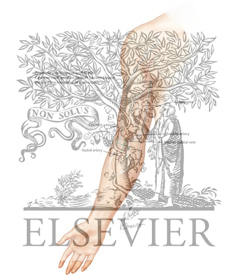 Prosthetic Arteriovenous Graft