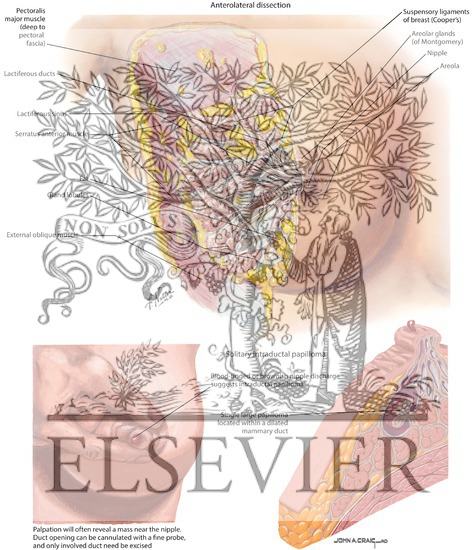 Duct Excision and Intraductal Papilloma