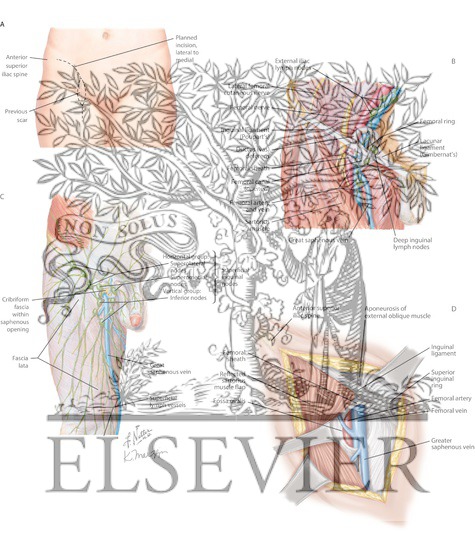 Inguinal Lymph Node Dissection Inguinal Lymph Node Dissection