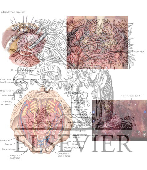 bladder neck dissection