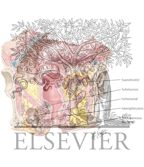 Proctologic Conditions IV - Anorectal Abscess and Fistula