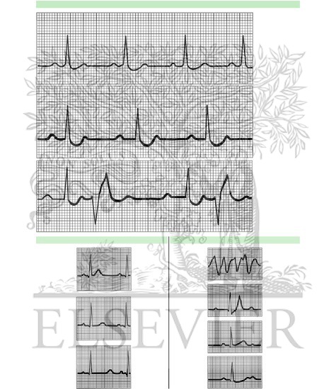 Effect of Digitalis and Calcium/Potassium Levels on Electrocardiogram