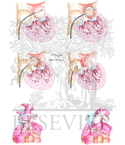 Transposition of the Great Vessels: Balloon Atrial Septostomy and ...