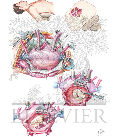 Mitral Valve Replacement
